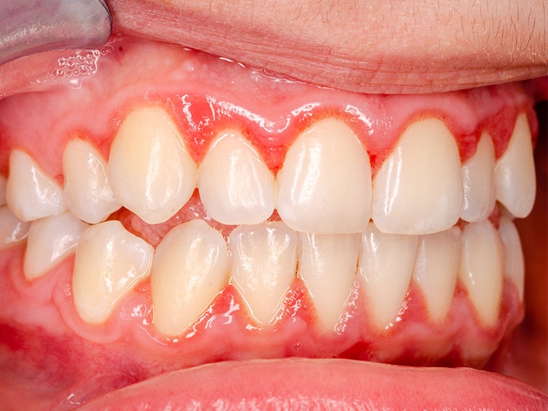 Periodontia em Goiânia - GO - MRJ Odonto Center
